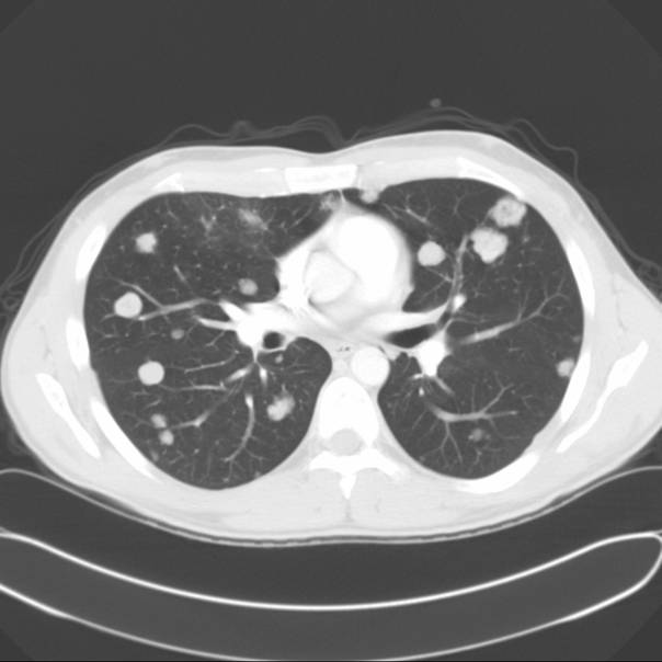 How To Interpret CT Scans Of Your Lung How To Interpret CT Scans Of Your Lung
